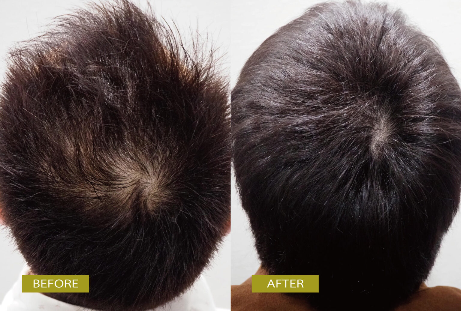 大阪AGA加藤クリニック 梅田 難波 PRP療法 薄毛治療 注入治療 AGA内服薬